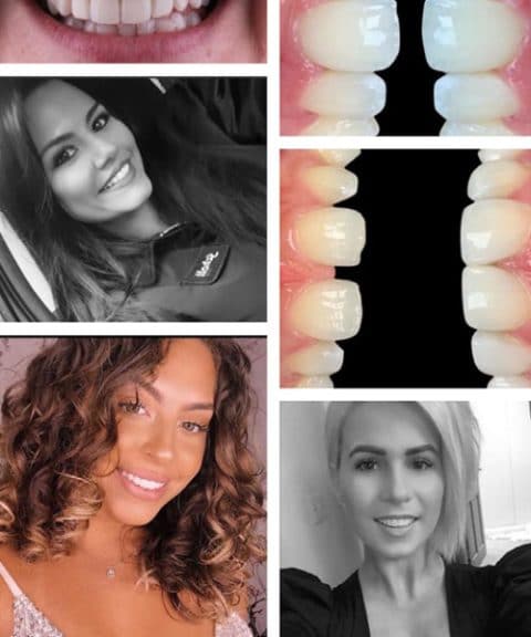 Composite Bonding in Ruislip | Dental Bonding in Ruislip